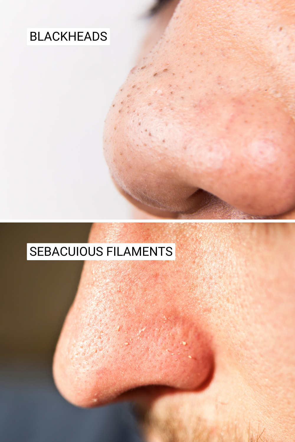 6 Ways To Get Rid Of Blackheads: Clear Skin, Here We Come!