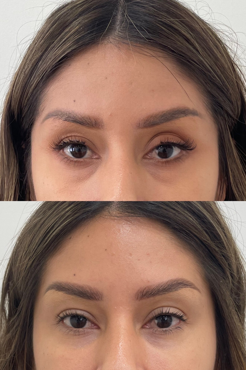 Tired Of Looking Tired? Here’s How To Get Rid Of Dark Circles For Good