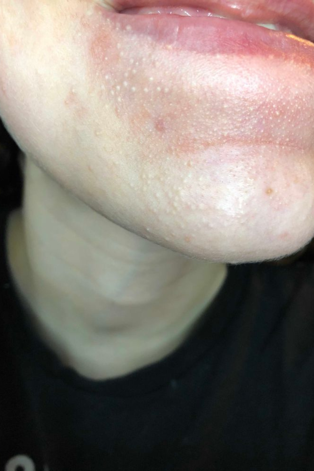 Closed Comedones Treatment 101 - Fast Solutions For Bumpy Skin Problems