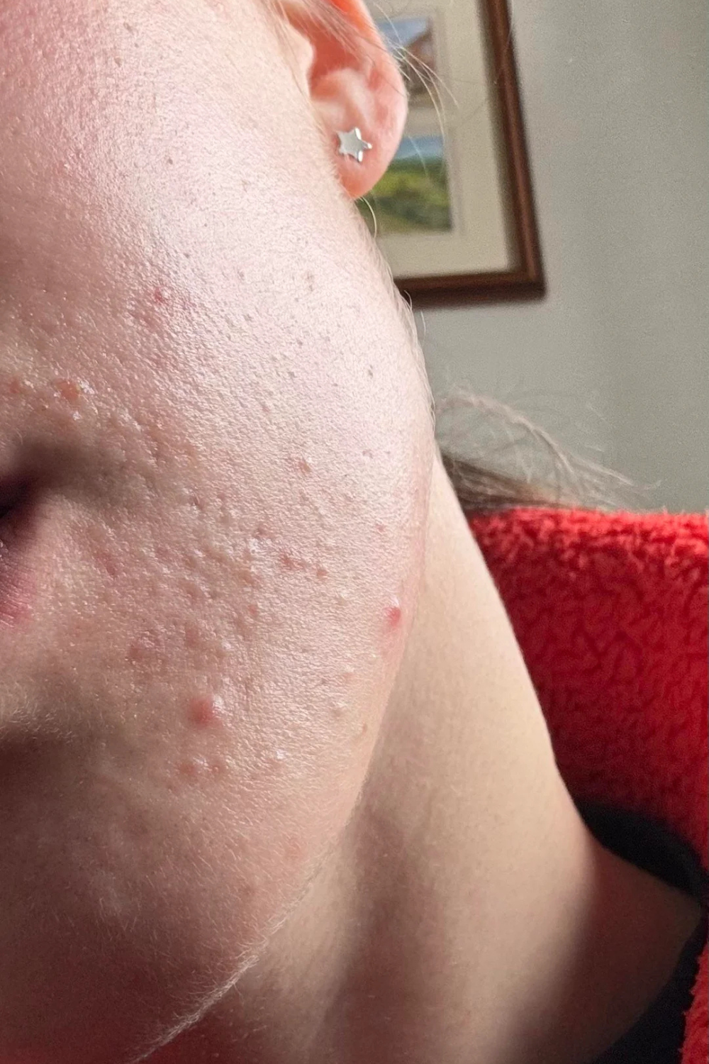 Closed Comedones Treatment 101 - Fast Solutions For Bumpy Skin Problems