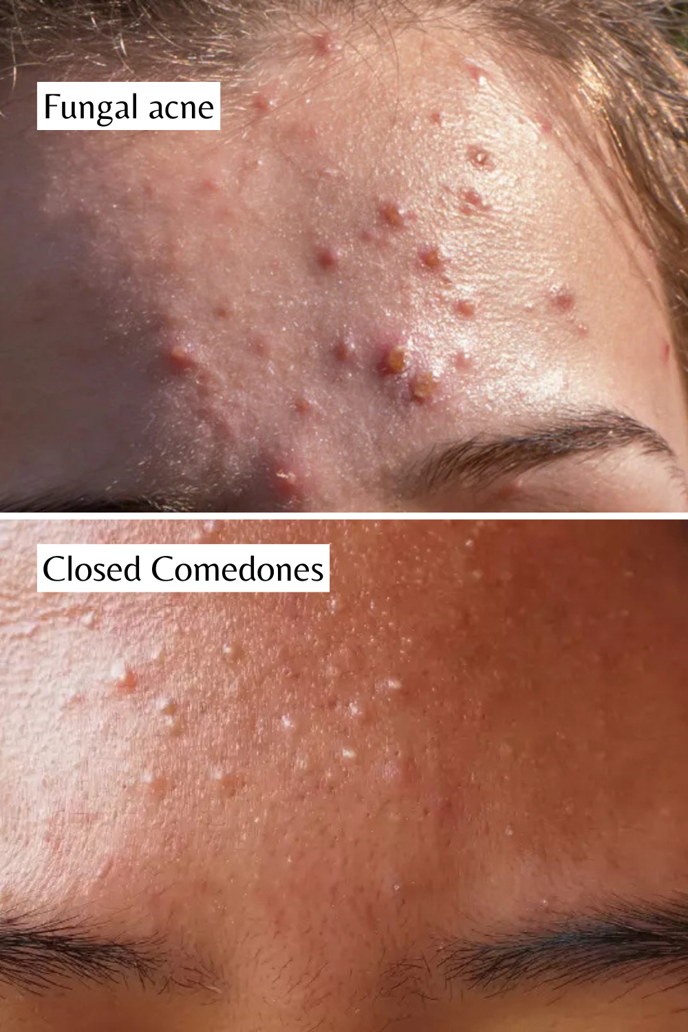 Closed Comedones Treatment 101 - Fast Solutions For Bumpy Skin Problems