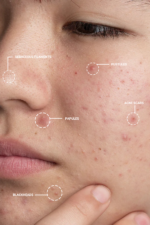 How To Get Rid Of Textured Skin On Face: 11 Treatments + 9 Lifestyle Fixes!